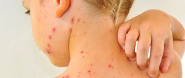 Comment soulager pour la varicelle ? La réponse est sur Admicile.fr